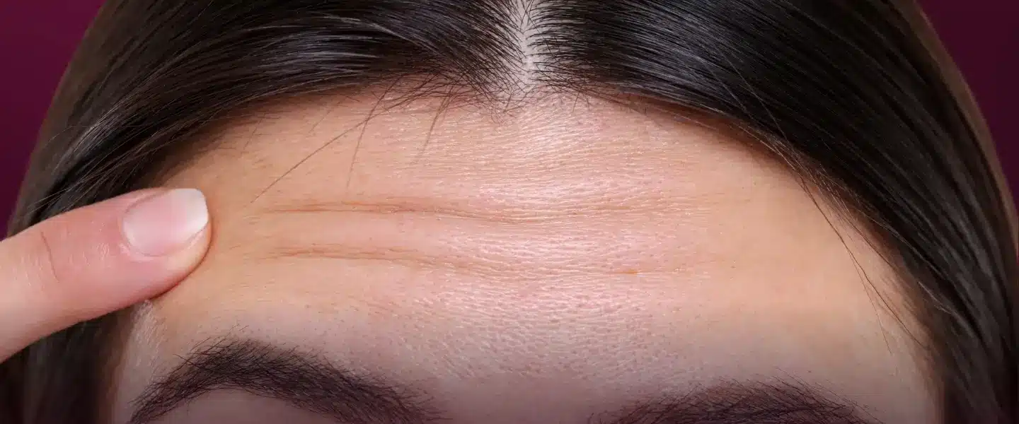 Garis Halus di Dahi: Kenali Tanda, Penyebab, dan Cara Mengatasinya ...